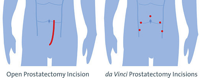 Καρκίνος Προστάτη | Δρ. Σταύρος Σφουγγαριστός - Ουρολόγος Ρόδος